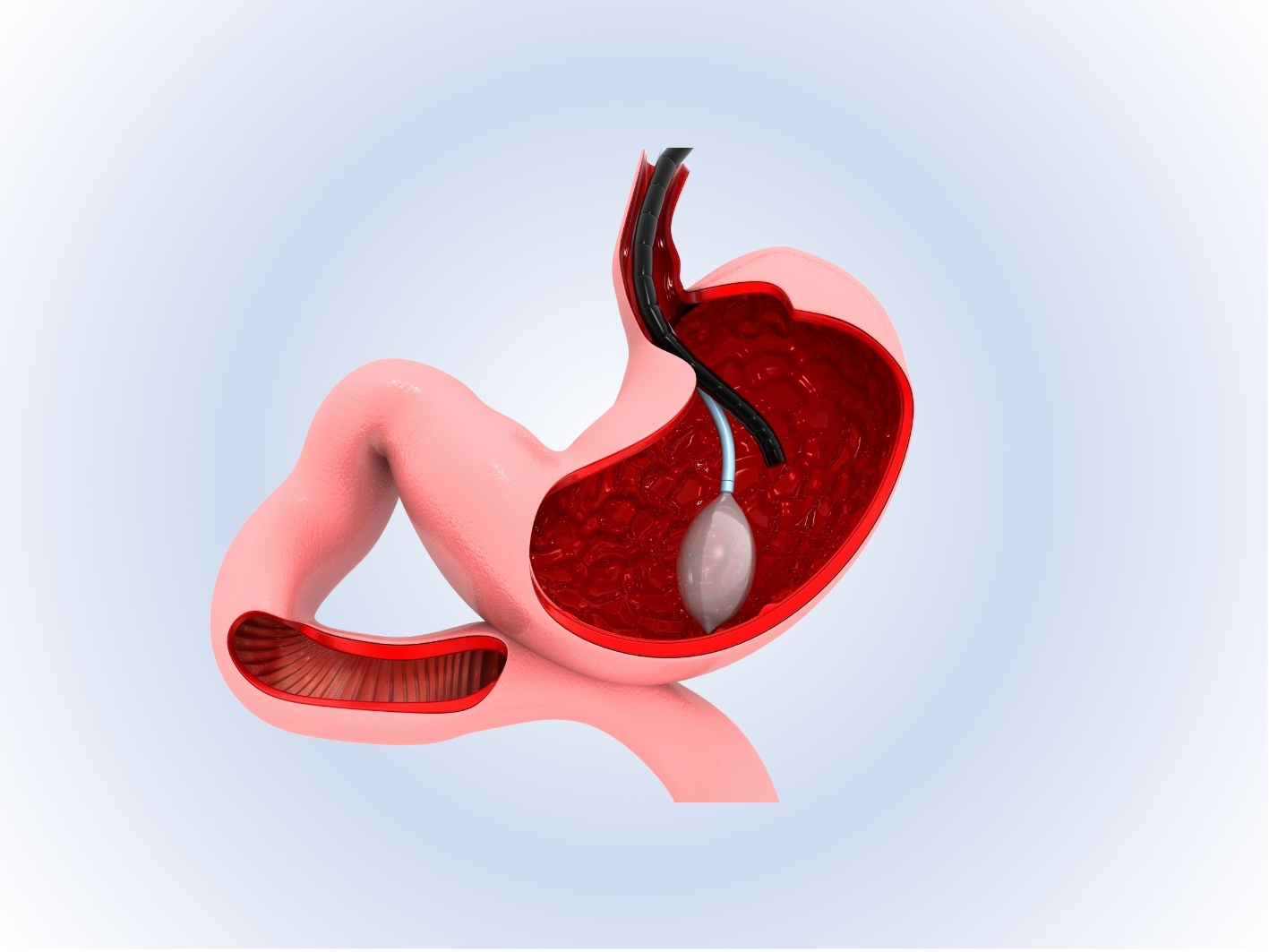 Intragastric Balloon - Türkçapar Bariatrics